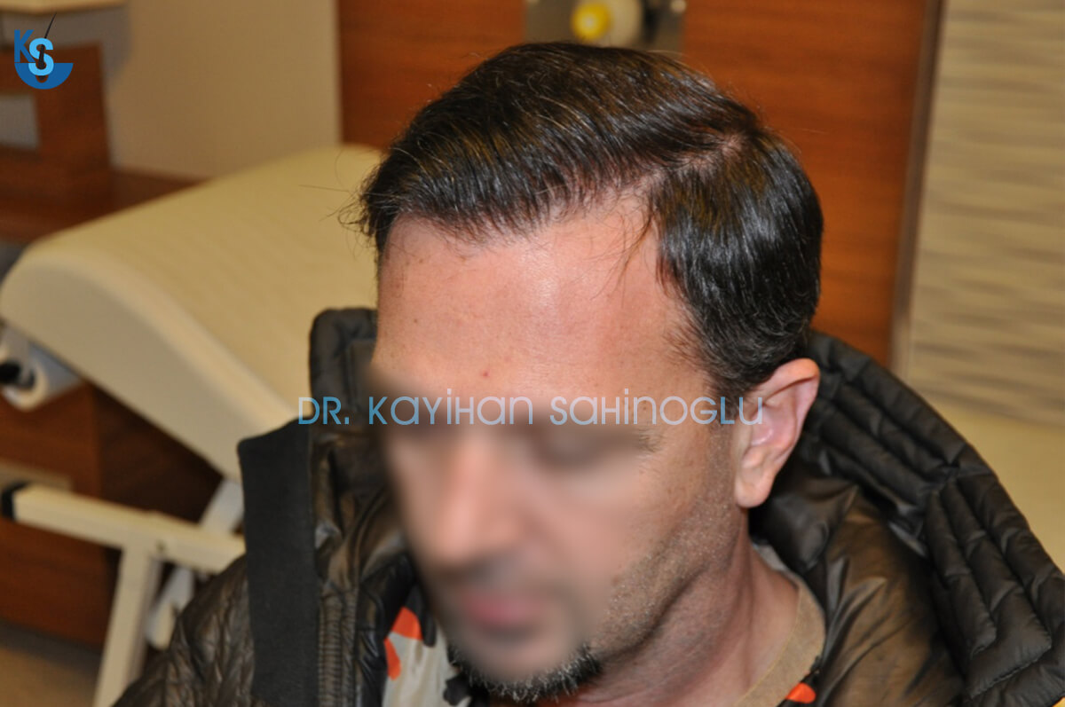 Hair Transplant Before After Photos - Get New Hair