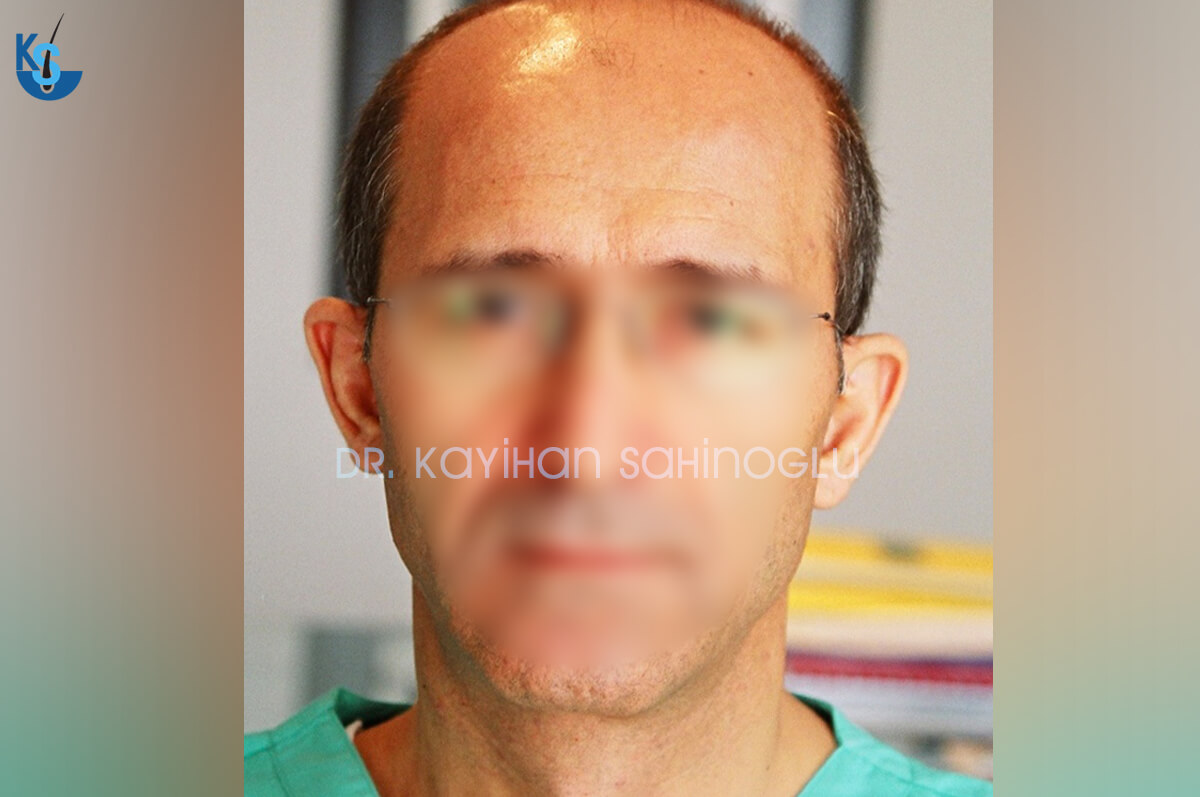 Hair Transplant Before After Photos - Get New Hair