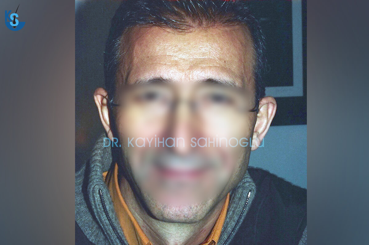 Hair Transplant Before After Photos - Get New Hair