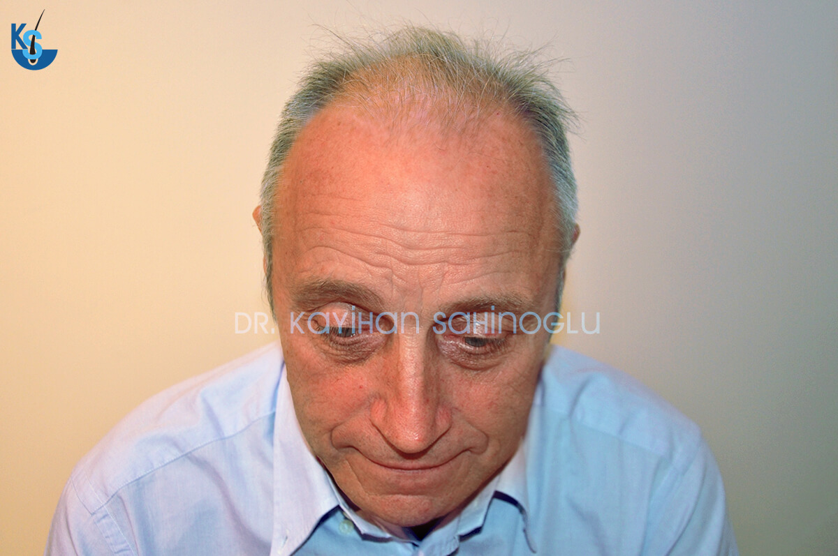 Hair Transplant Before After Photos - Get New Hair